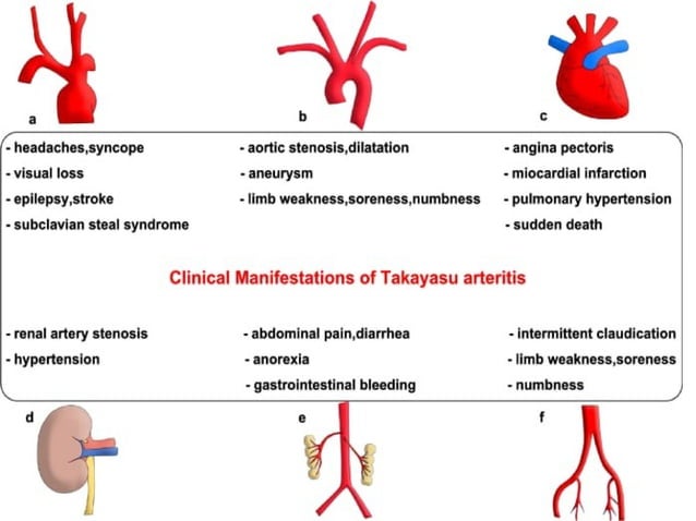 TAKAYASU'S ARTERITIS OVERVIEW OF MEDICAL SURGICAL NURSING..pptx