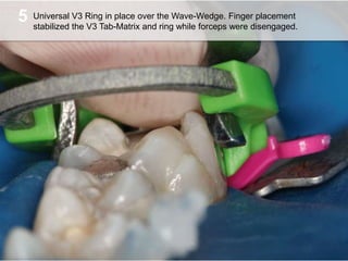 Do cavity on upper first molar by dr simon mc donald | PPTX