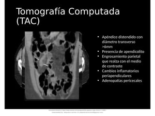docsity-apendicitis-aguda-y-caso-clinico.pdf