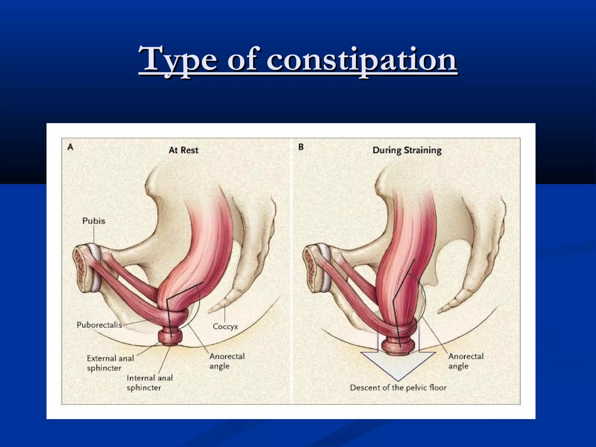 CONSTIPATION | PPT