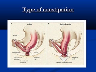 CONSTIPATION | PPT