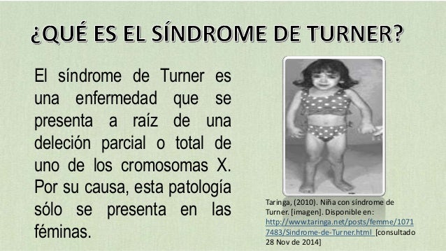 Síndrome De Turner
