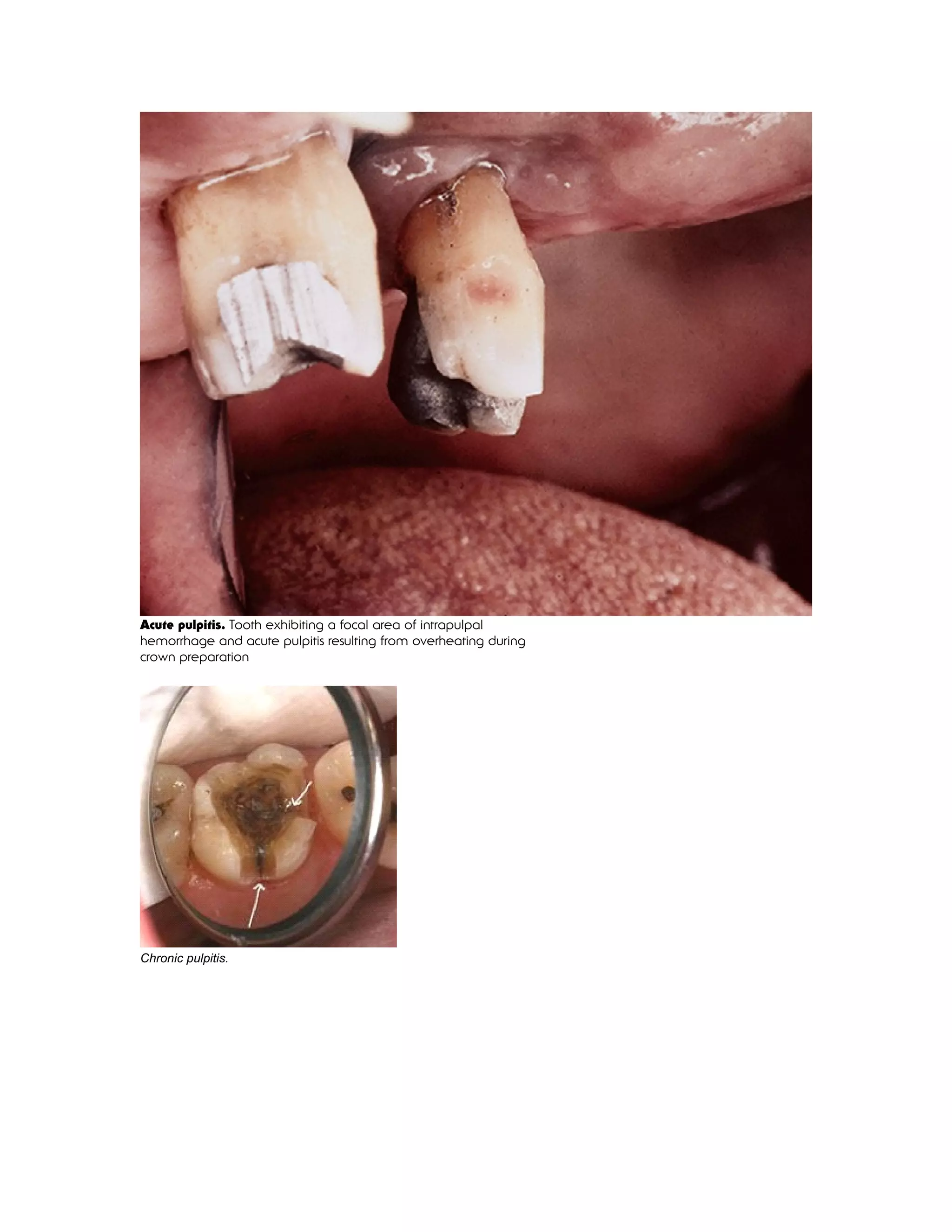 Pulpitis | RTF | Dental Health | Diseases and Conditions