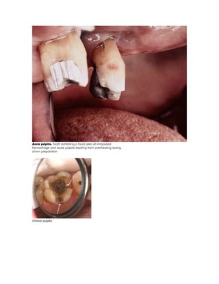 Pulpitis | RTF | Dental Health | Diseases and Conditions