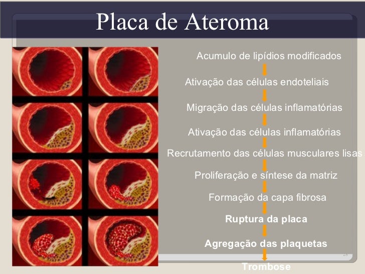 Doença Arterial Coronariana