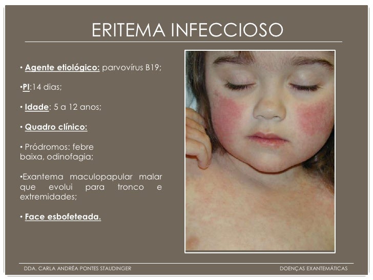 Doenças+exantemática