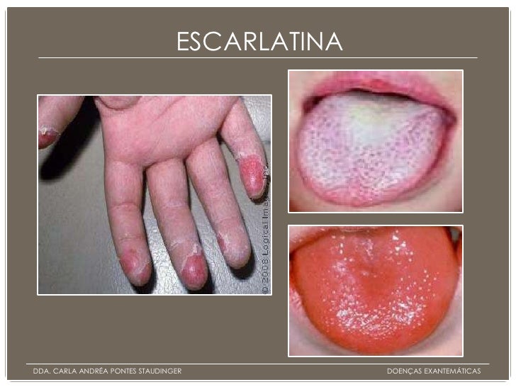 Doenças+exantemática