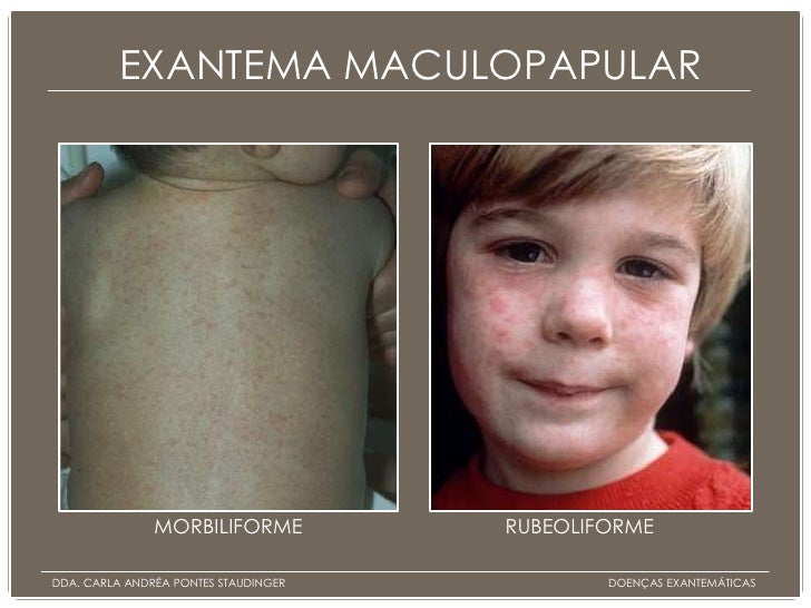 Doenças+exantemática