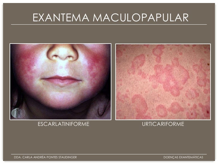 Doenças+exantemática