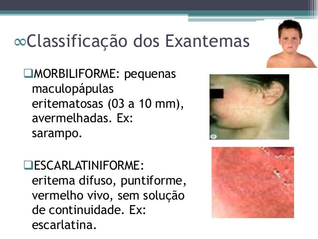 Doenças exantemáticas