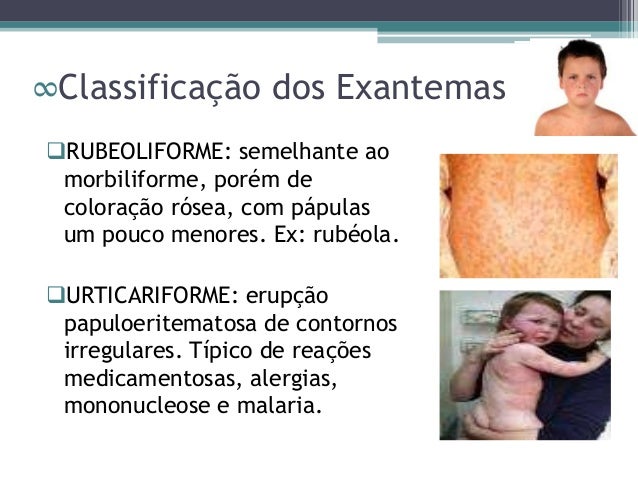 Doenças exantemáticas