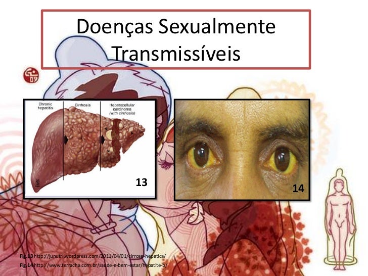 Doenças sexualmente transmissíveis