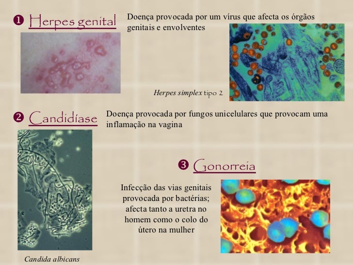 Doenças sexualmente transmissíveis e sida