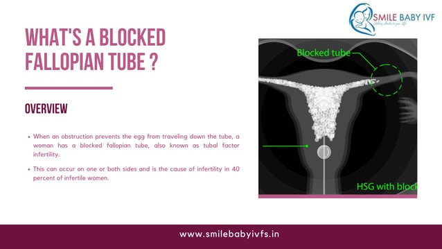Does ovulation stop in case of a fallopian tube blockage | PPT