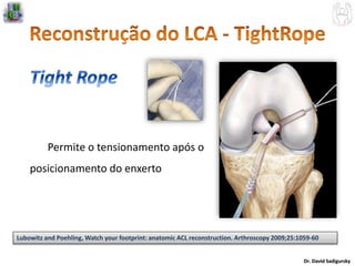 Reconstrução do Ligamento Cruzado Anterior com técnica All-inside ...