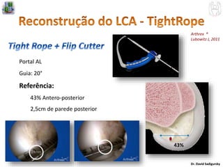 Reconstrução do Ligamento Cruzado Anterior com técnica All-inside ...
