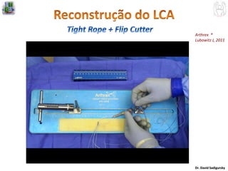 Reconstrução do Ligamento Cruzado Anterior com técnica All-inside ...