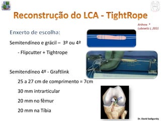Reconstrução do Ligamento Cruzado Anterior com técnica All-inside ...