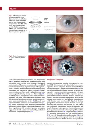 Dohlman2014 article the_bostonkeratoprosthesis2014a | PDF | Eye and ...