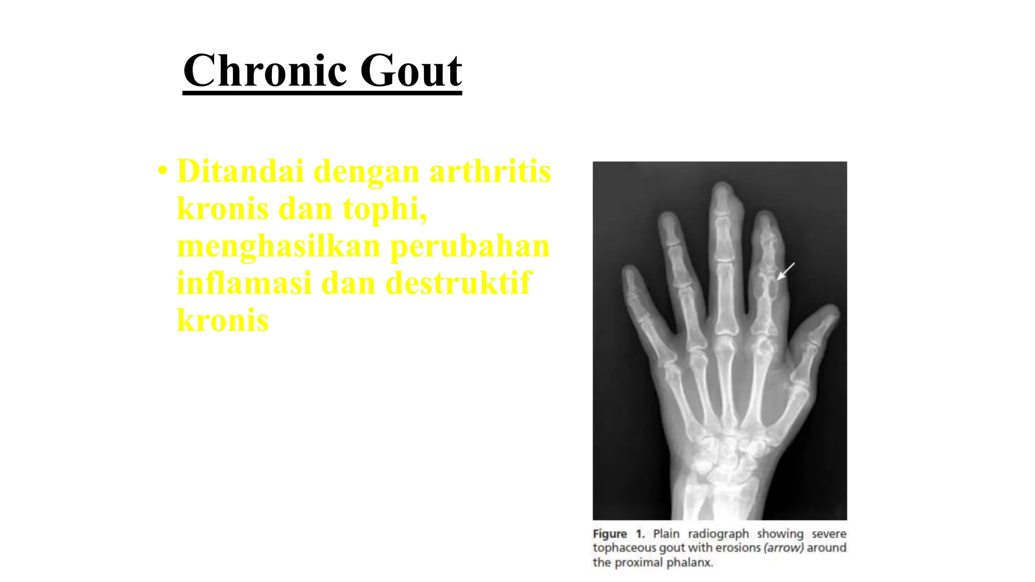 Morning report materi Gout Arthritis.pptx
