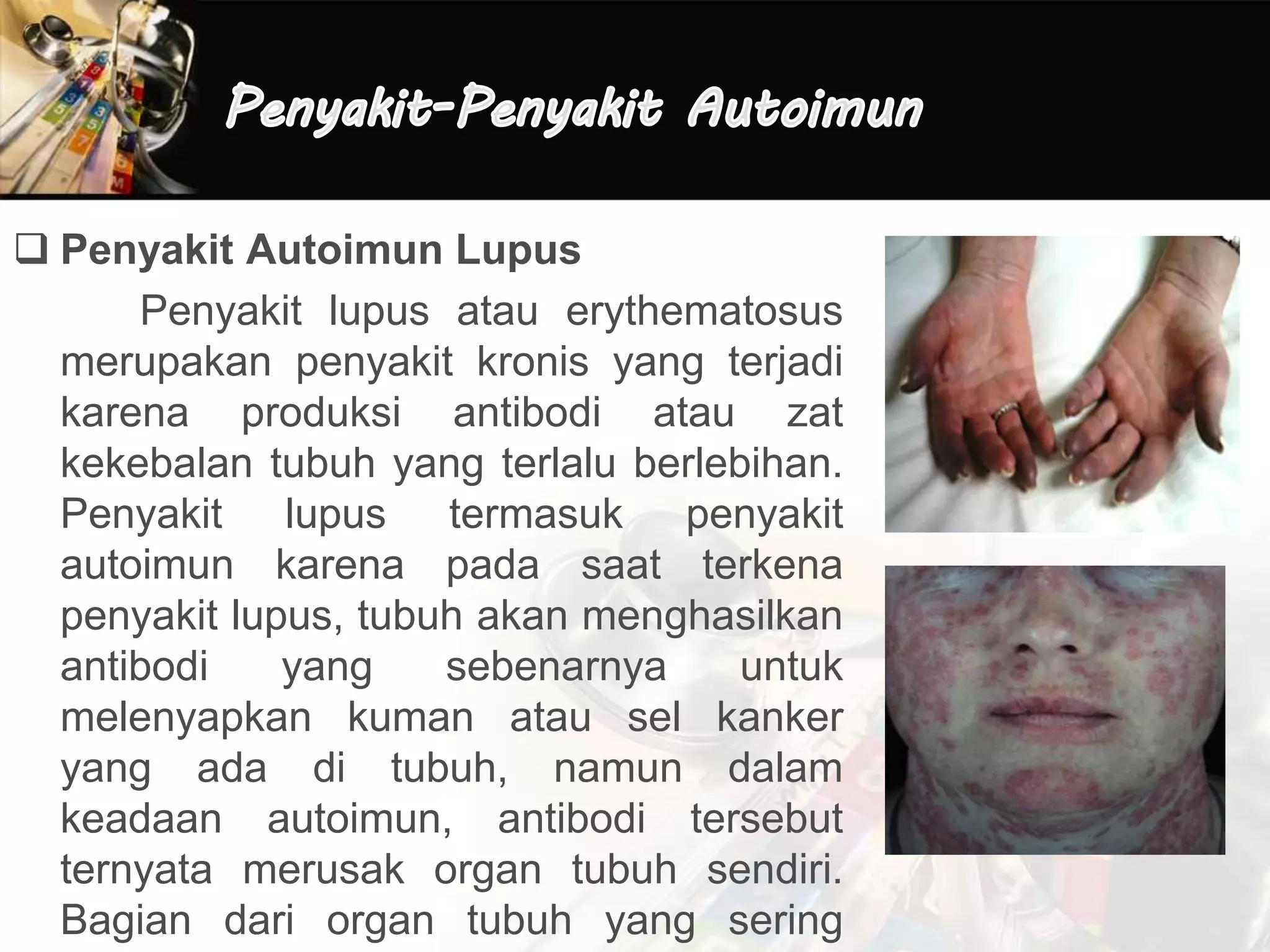 dokumen.tips_ppt-autoimun.pptx