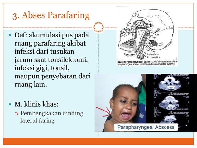 dokumen.tips_abses-leher-dalam-56c7227d3fff2.pptx