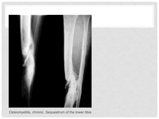 dokumen.tips_ppt-osteomielitis-560711ac493b9.ppt
