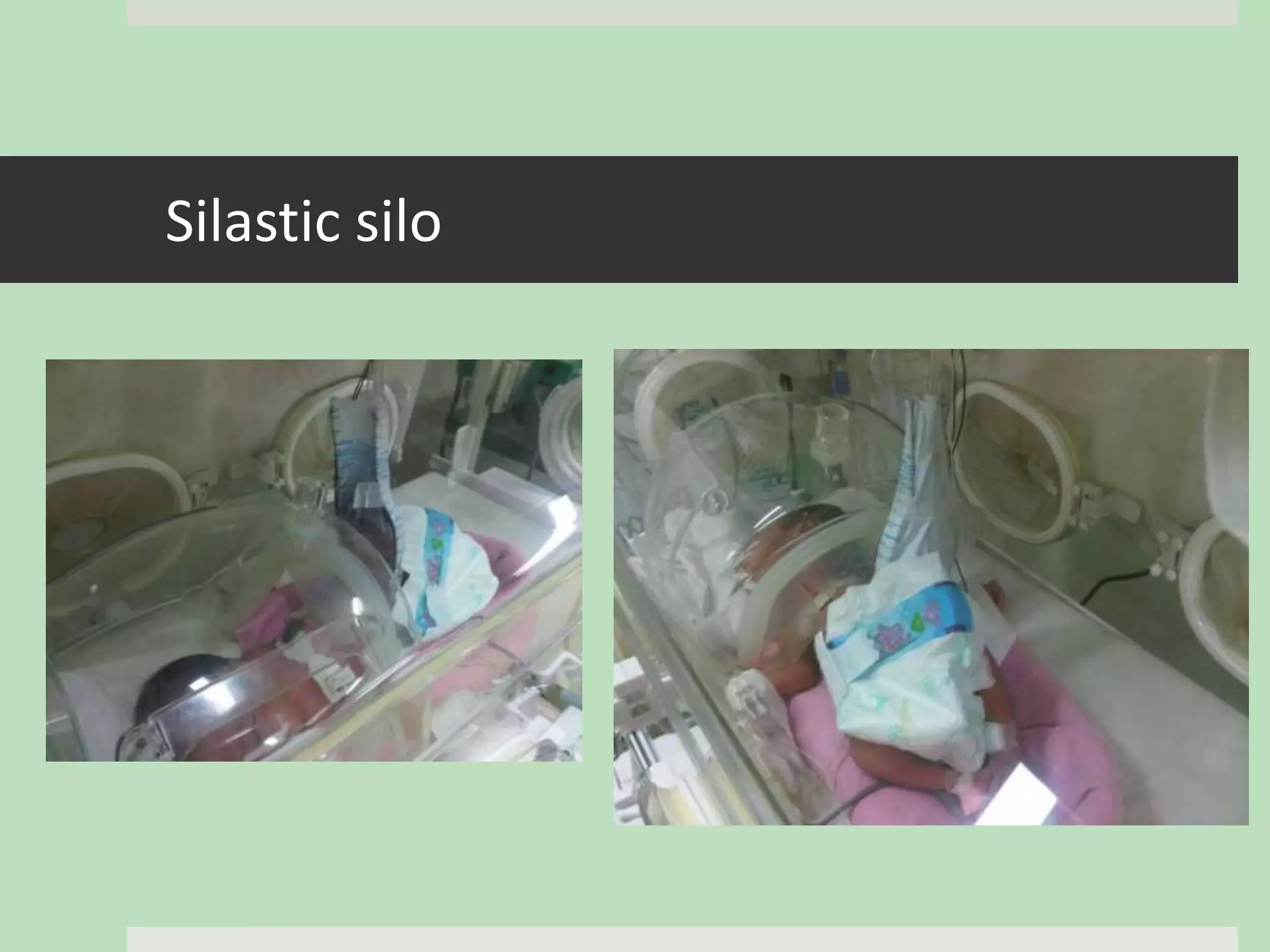 dokumen.tips_ppt-gastroschisis.ppt