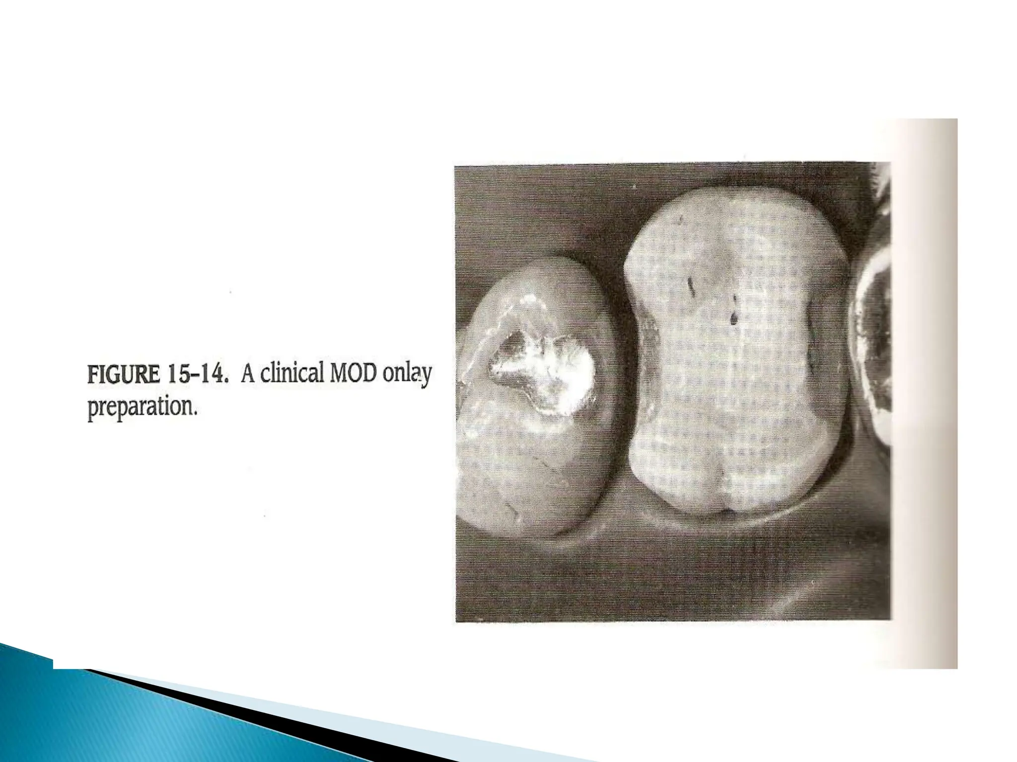 dokumen.tips_inlay-dan-onlay-56a363d7a8b1a.ppt