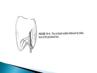 dokumen.tips_inlay-dan-onlay-56a363d7a8b1a.ppt
