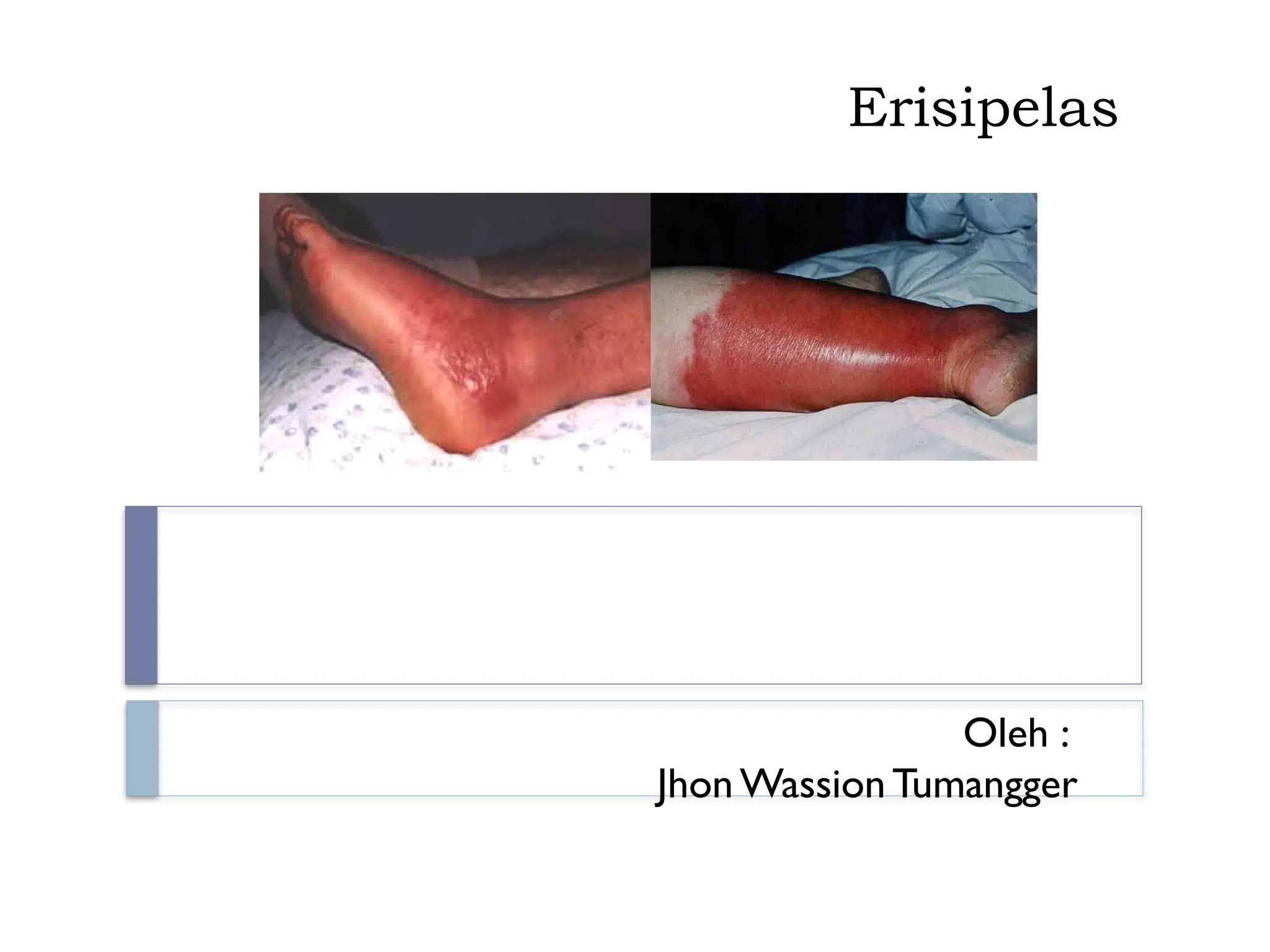 dokumen.tips_perbedaan-erisipelas-dan-seluitis.pptx