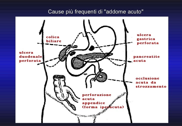 Dolore Addome Acuto