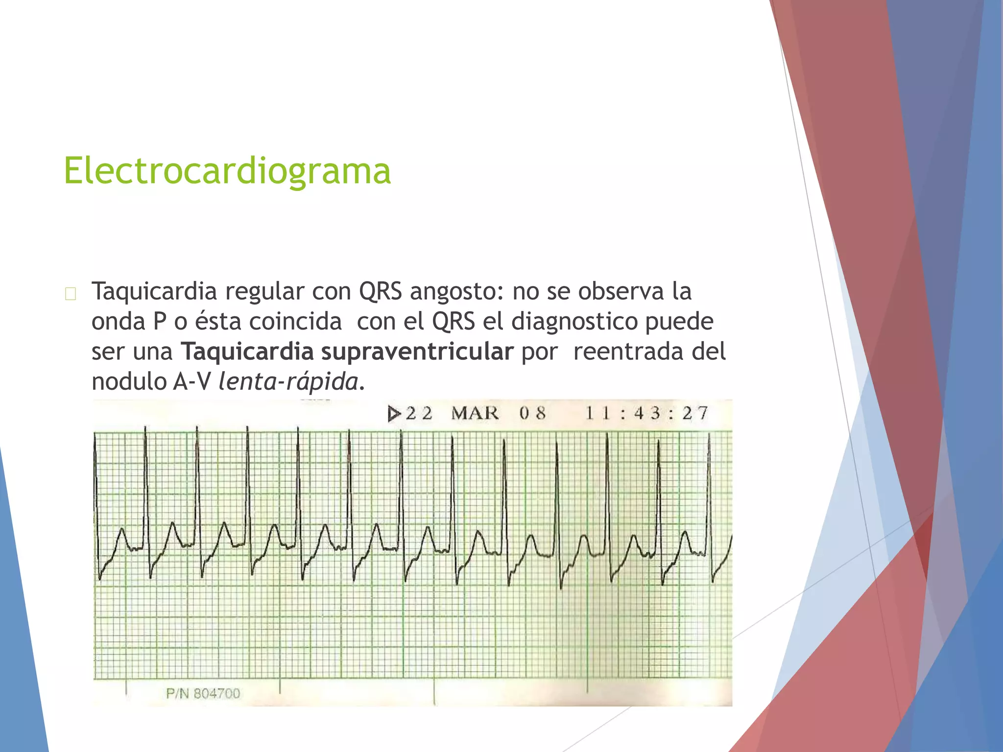 DOLOR RETROESTERNAL Y PALPITACION.pptx