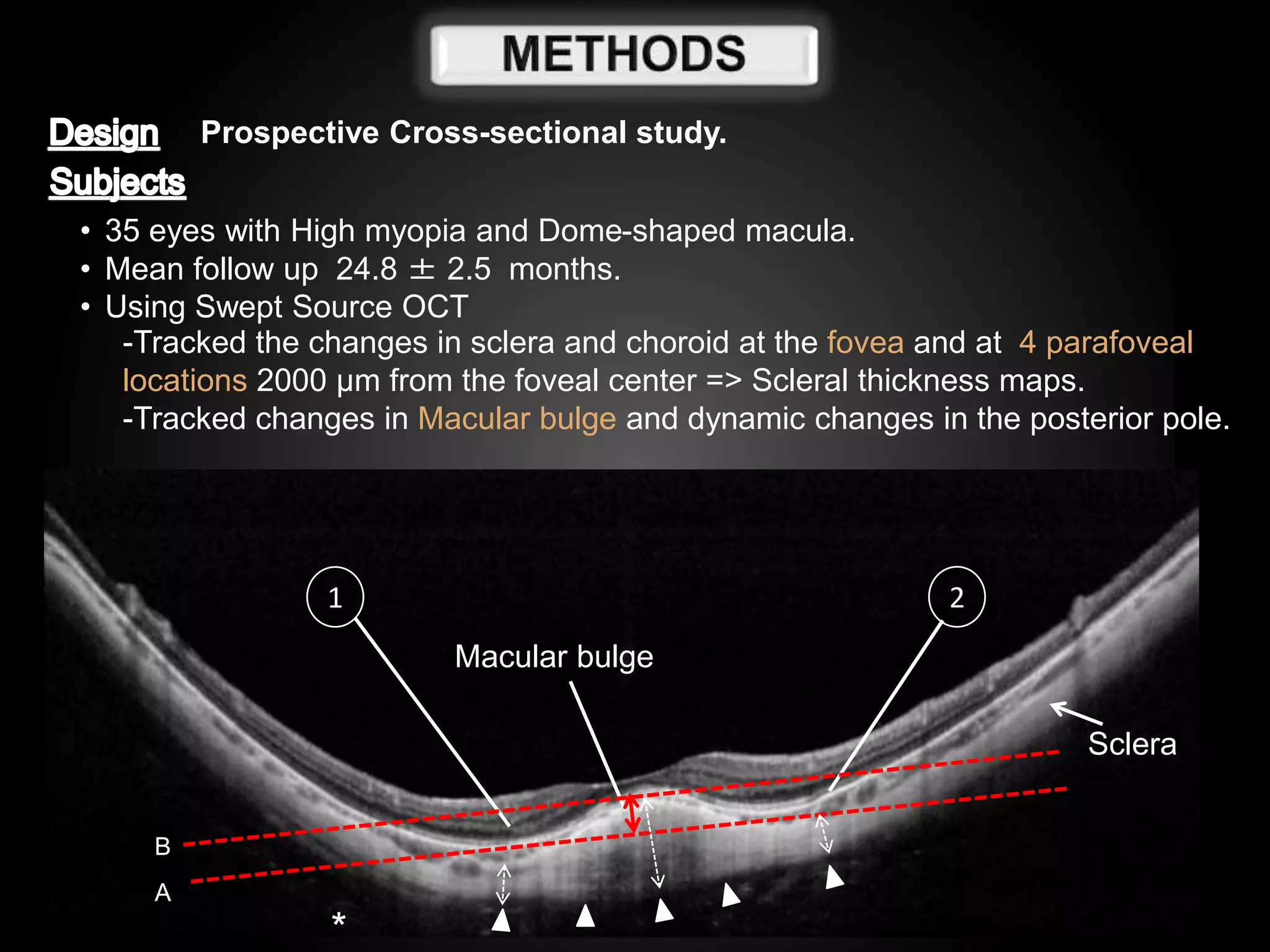 Dome shaped macula in High myopia - Swept-source Optical coherence ...