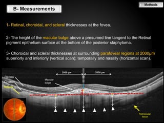 Dome shaped macula in High myopia - Swept-source Optical coherence ...