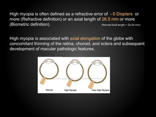 Dome shaped macula in High myopia - Swept-source Optical coherence ...