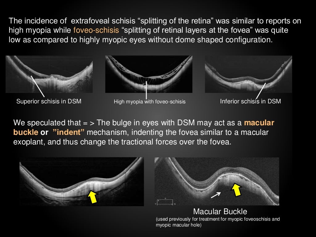 Dome shaped macula in High myopia - Swept-source Optical coherence t…