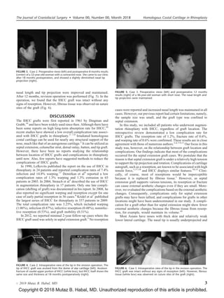 Donated rib cartilage in rhinoplasty | PDF