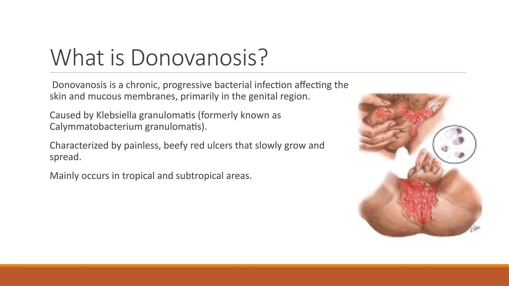 Donovanosis - Understanding Granuloma Inguinale (Dermatology presentation) | PPTX