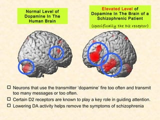 Schizophrenia Brain Dopamine