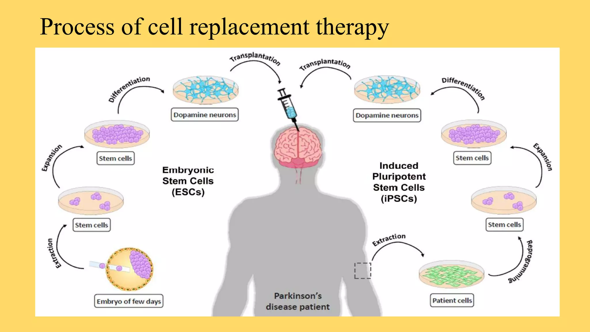 Dopaminergic cell replacement therapy in Parkinson disease by ...