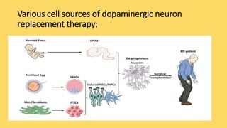 Dopaminergic cell replacement therapy in Parkinson disease by ...