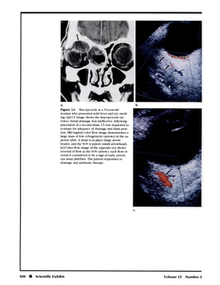 Dopler eye | PDF
