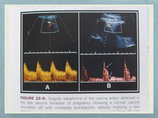 Doppler | PPT