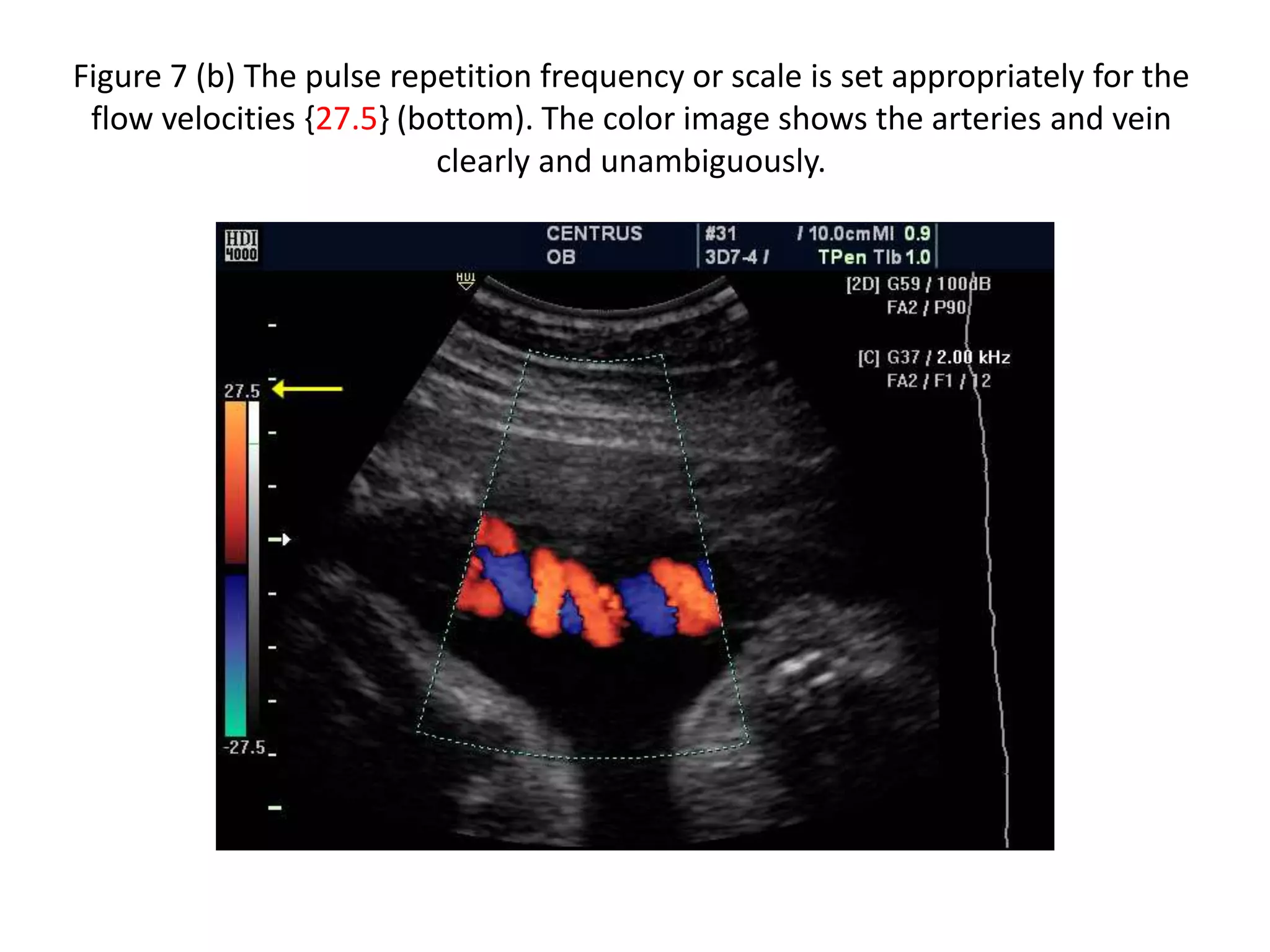 Doppler artefact (1) | PPTX
