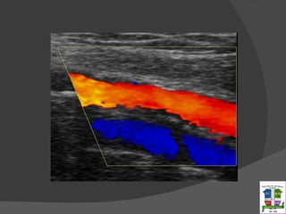 Doppler arterial | PPT