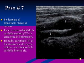 DOPPLER DUPLEX CÁROTIDEO | PPT