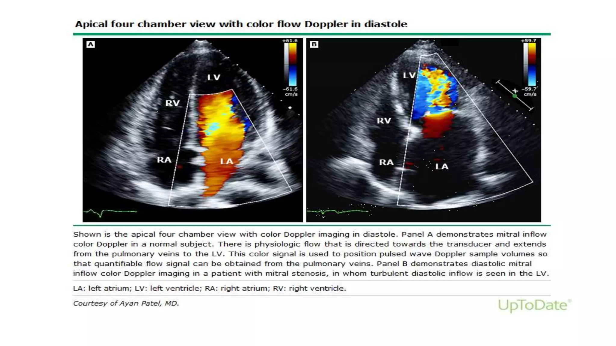 Doppler echocardiography | PPTX