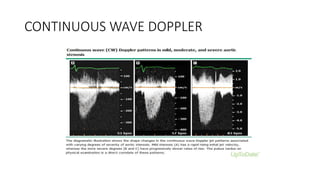 Doppler echocardiography | PPTX