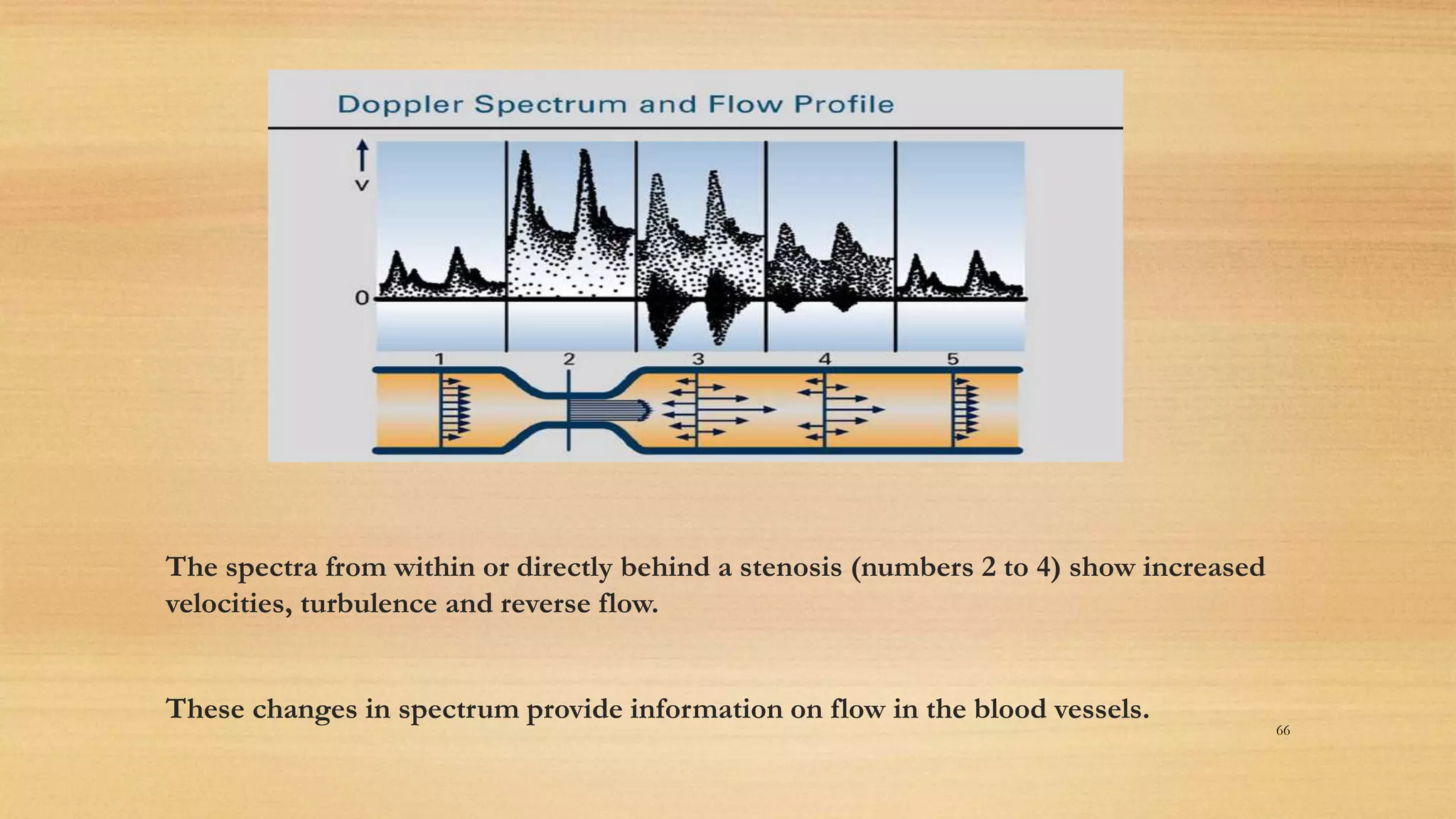 Doppler Effect - Ultrasound